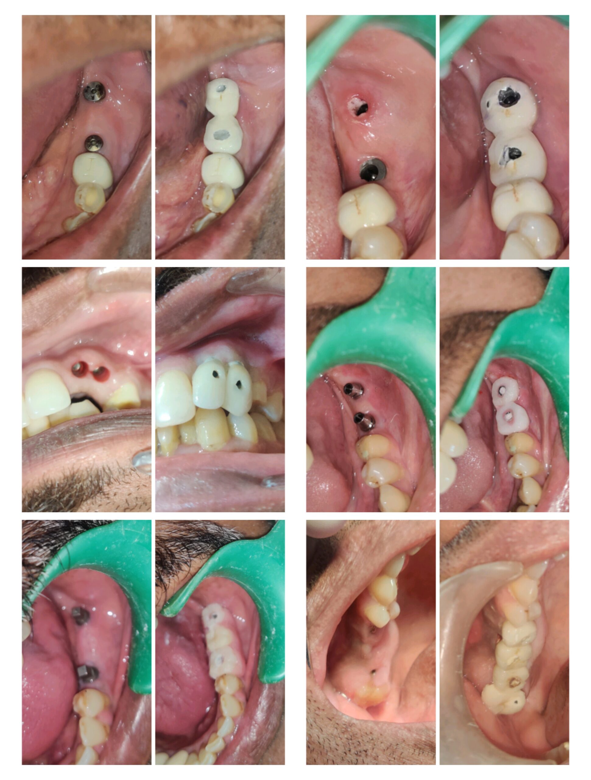 Prosthetic Phase Dental Implants – Discuss Dentistry